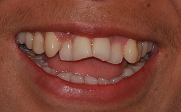 Smile Gallery - Fort Dental Clinic