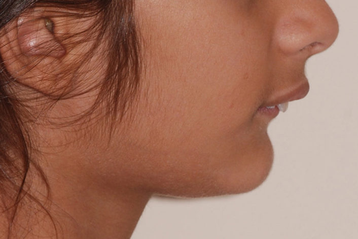 Smile Gallery - Fort Dental Clinic