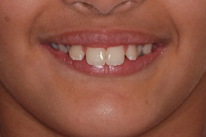 Smile Gallery - Fort Dental Clinic