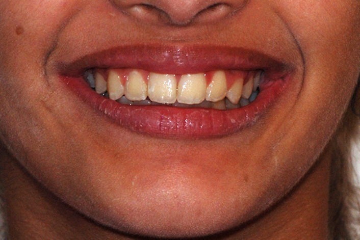 Smile Gallery - Fort Dental Clinic