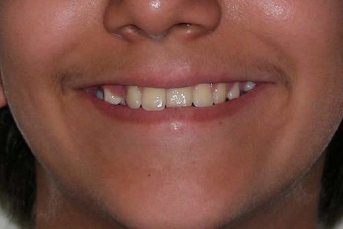 Smile Gallery - Fort Dental Clinic