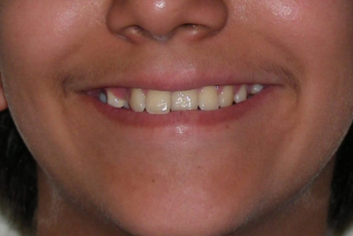 Smile Gallery - Fort Dental Clinic