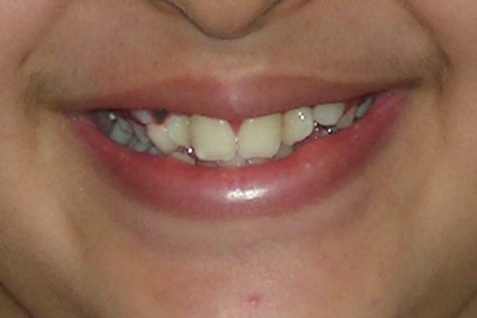 Smile Gallery - Fort Dental Clinic