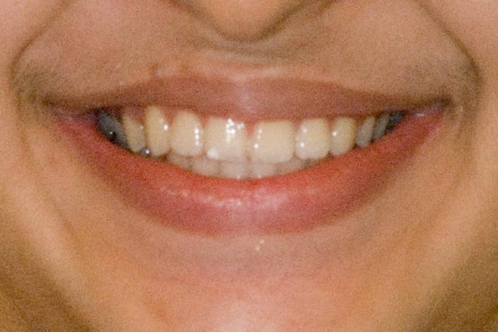 Smile Gallery - Fort Dental Clinic