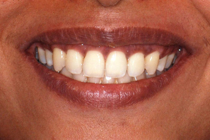Smile Gallery - Fort Dental Clinic