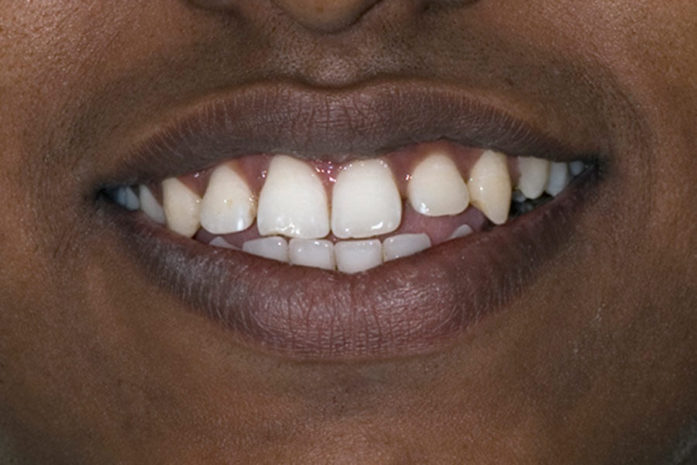 Smile Gallery - Fort Dental Clinic