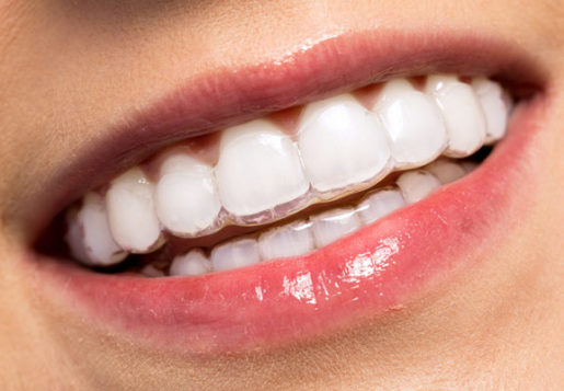 Invisalign in Mumbai, Cost-Effective Clear Aligners & Invisible Braces ...