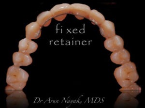 Retainer after braces or invisalign - prevent teeth relapse