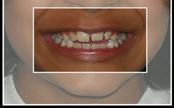 Thumb sucking and incomplete bites!!! - Fort Dental Clinic