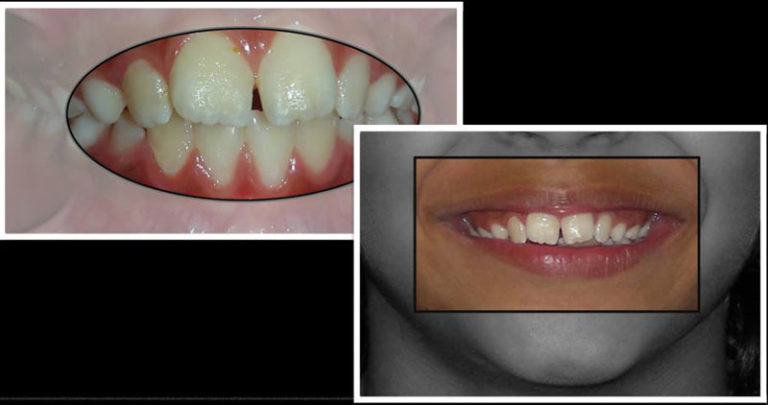 Thumb sucking and incomplete bites!!! - Fort Dental Clinic