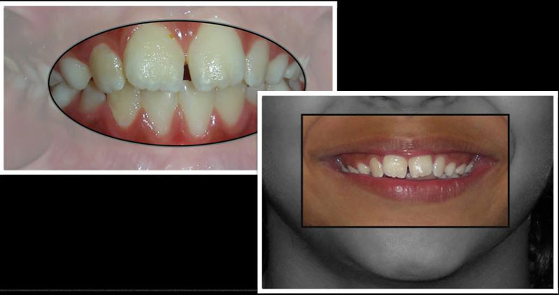 Thumb sucking and incomplete bites!!! - Fort Dental Clinic