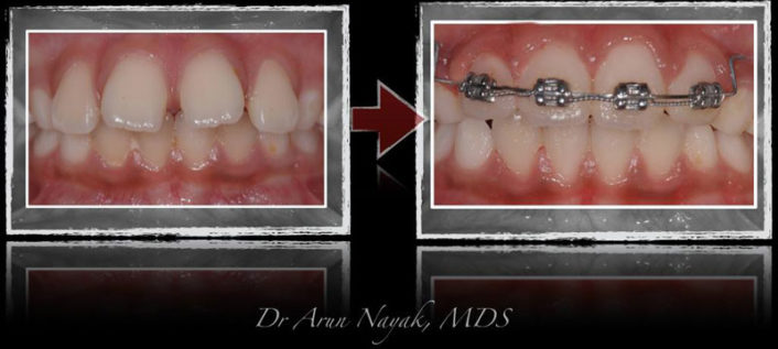Phase One Orthodontics - Fort Dental Clinic