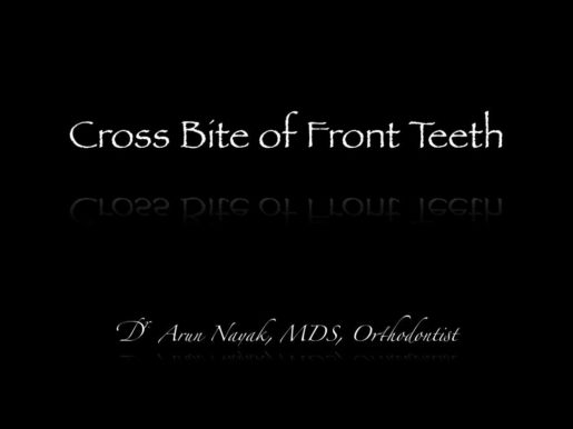 Cross Bite of Front Teeth - Fort Dental Clinic