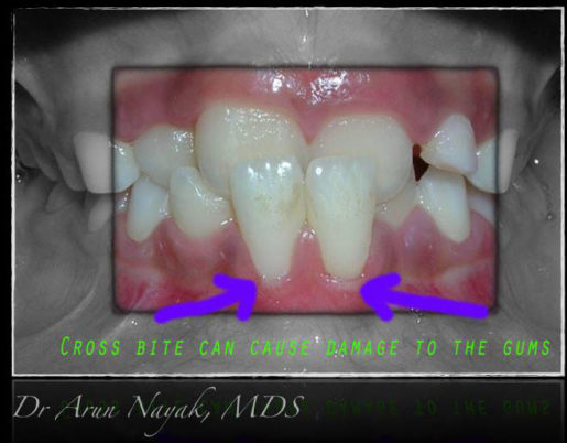 Cross Bite of Front Teeth - Fort Dental Clinic