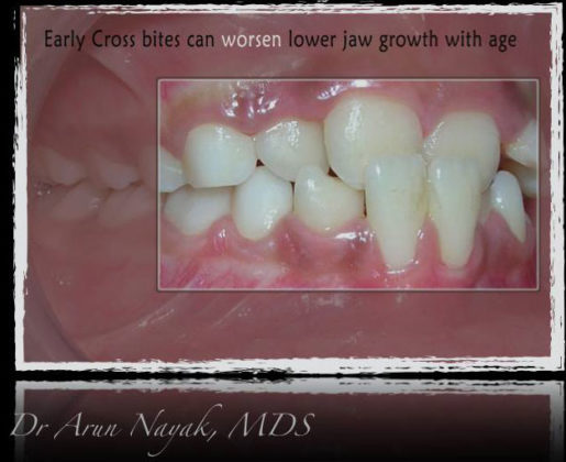 Cross Bite of Front Teeth - Fort Dental Clinic