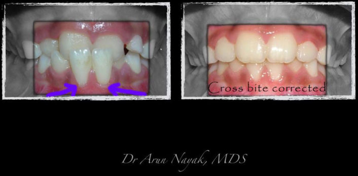 Cross Bite of Front Teeth - Fort Dental Clinic