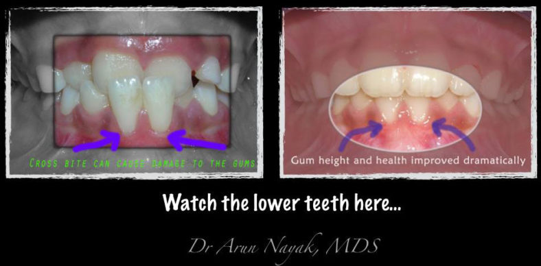 Cross Bite of Front Teeth - Fort Dental Clinic