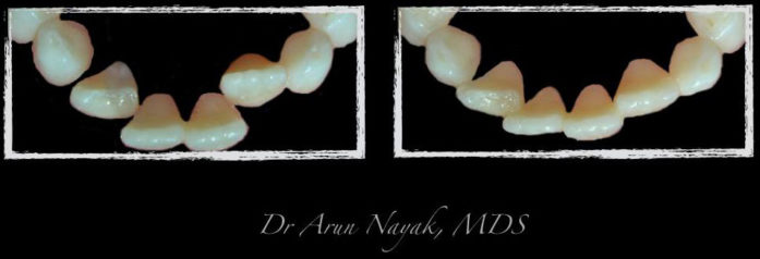 Cross Bite of Front Teeth - Fort Dental Clinic