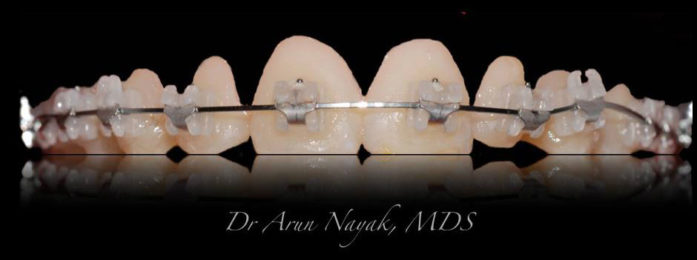 Cross Bite of Front Teeth - Fort Dental Clinic