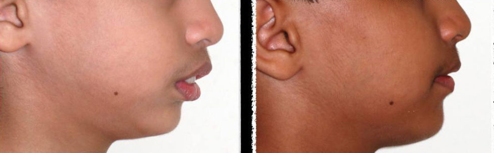 Narrow Upper Jaw Problem - Fort Dental Clinic