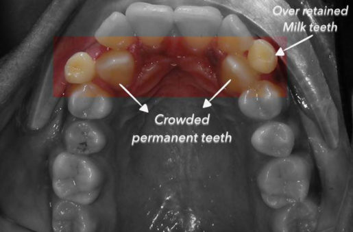 Over Retained Milk Teeth - Fort Dental Clinic