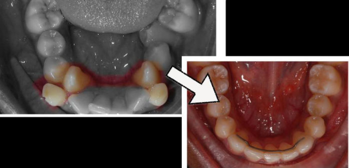 Over Retained Milk Teeth - Fort Dental Clinic