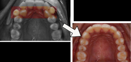 Over Retained Milk Teeth - Fort Dental Clinic