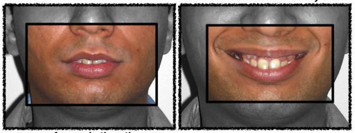 Small Jaws in Adults - Fort Dental Clinic