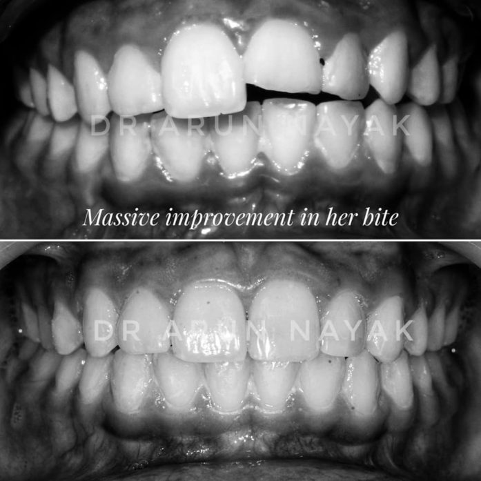 Molar distalization with Invisalign aligners - Fort Dental Clinic