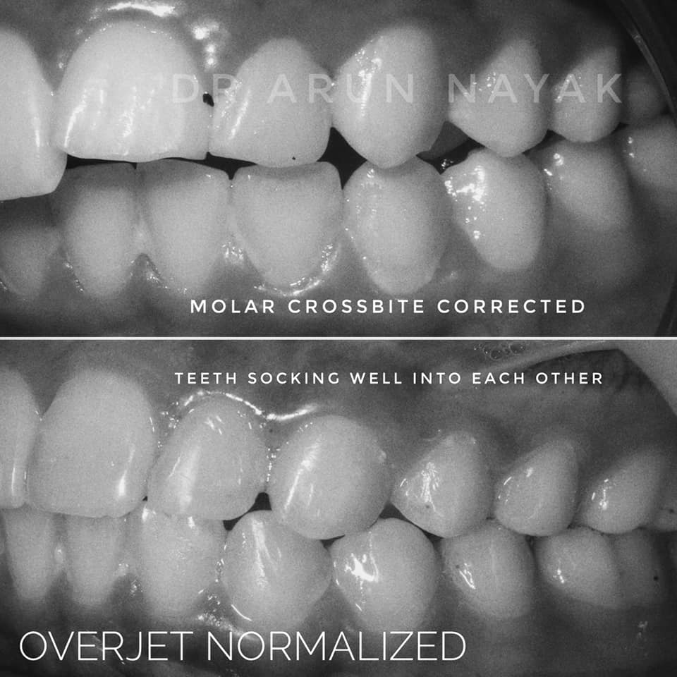 Molar distalization with Invisalign aligners - Fort Dental Clinic