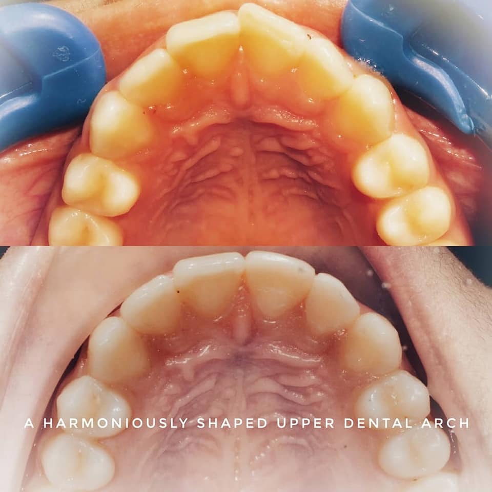 Molar distalization with Invisalign aligners - Fort Dental Clinic