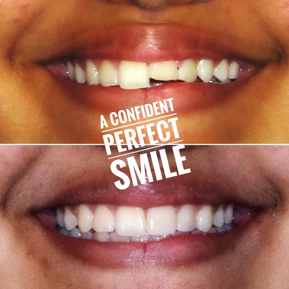 Molar distalization with Invisalign aligners - Fort Dental Clinic