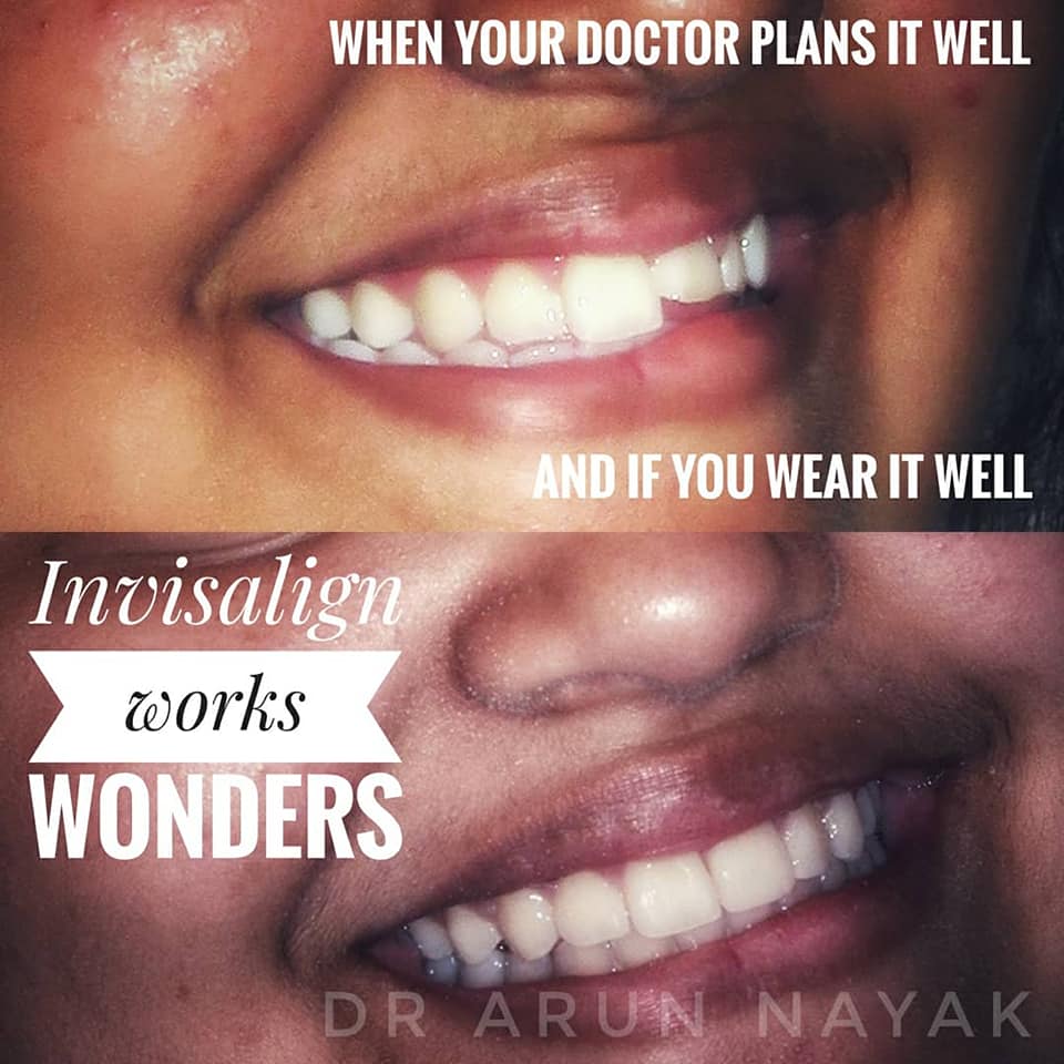 Molar distalization with Invisalign aligners - Fort Dental Clinic