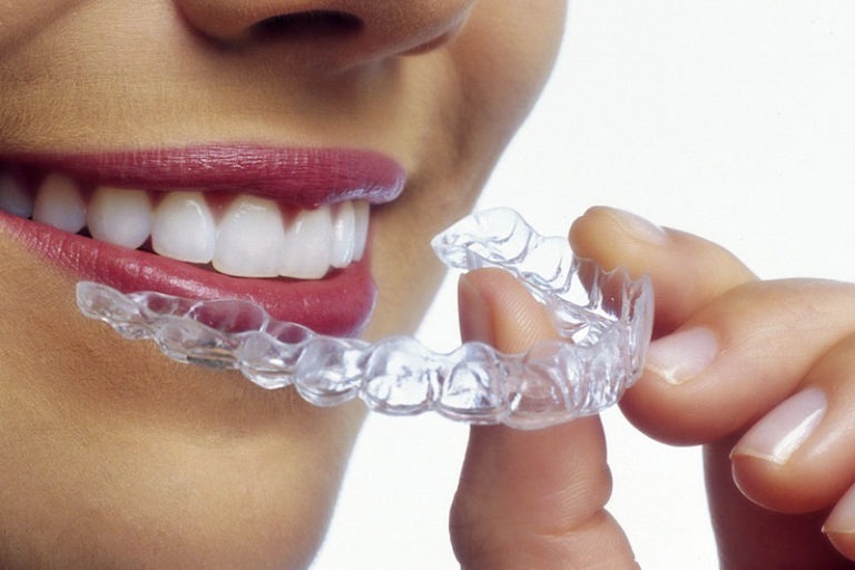 Retainer after braces or invisalign - prevent teeth relapse