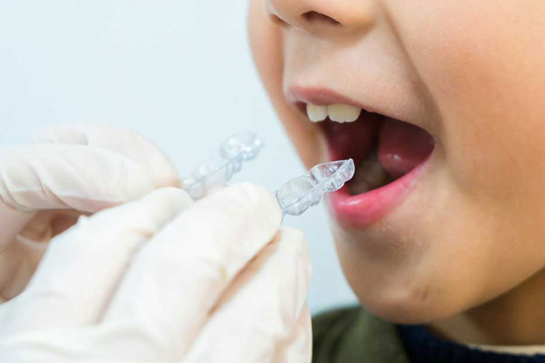 Invisalign in Mumbai, Cost-Effective Clear Aligners & Invisible Braces ...