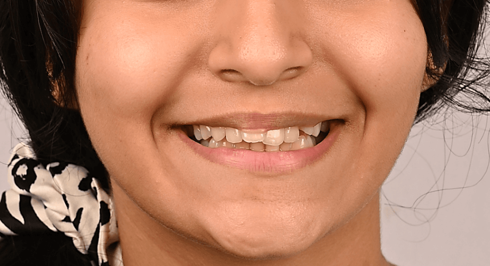 Invisalign in Mumbai, Cost-Effective Clear Aligners & Invisible Braces ...