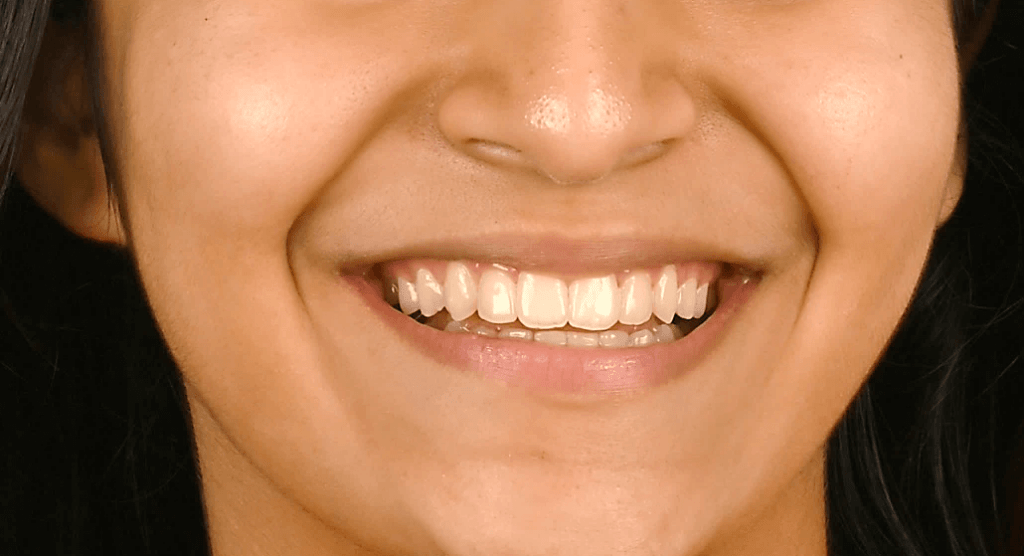 Invisalign in Mumbai, Cost-Effective Clear Aligners & Invisible Braces ...