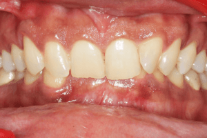 Invisalign in Mumbai, Cost-Effective Clear Aligners & Invisible Braces ...