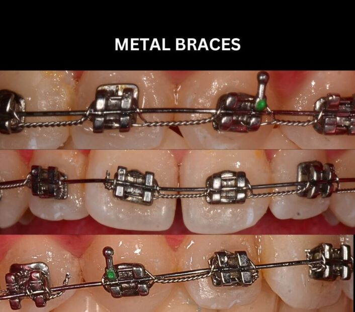 Metal Braces vs Ceramic Braces – Which is Better for You?