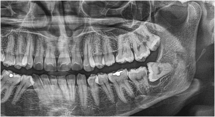 All About Wisdom Teeth Pain: Causes, Impaction, and Removal Process
