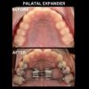 Palatal Expander Before & After Results at Fort Dental Clinic Mumbai