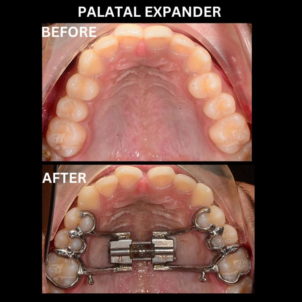Palatal Expander Before & After Results at Fort Dental Clinic Mumbai
