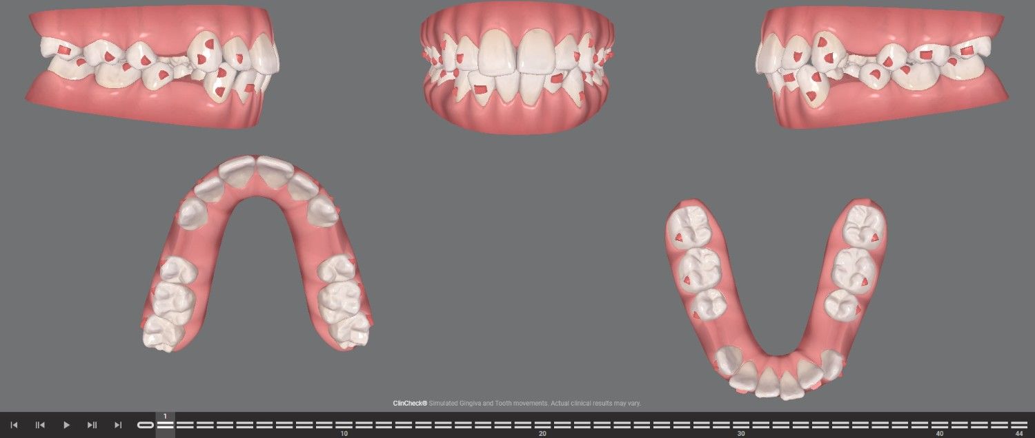 Four Premolar Extraction with Invisalign – Real Case Study