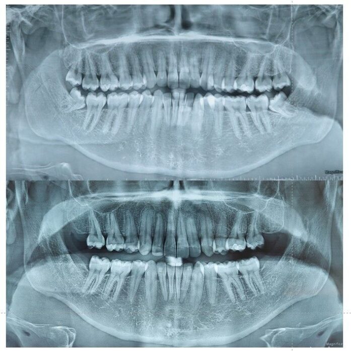 Invisalign Treatment Planning & 3D Smile Preview, Fort Dental Clinic